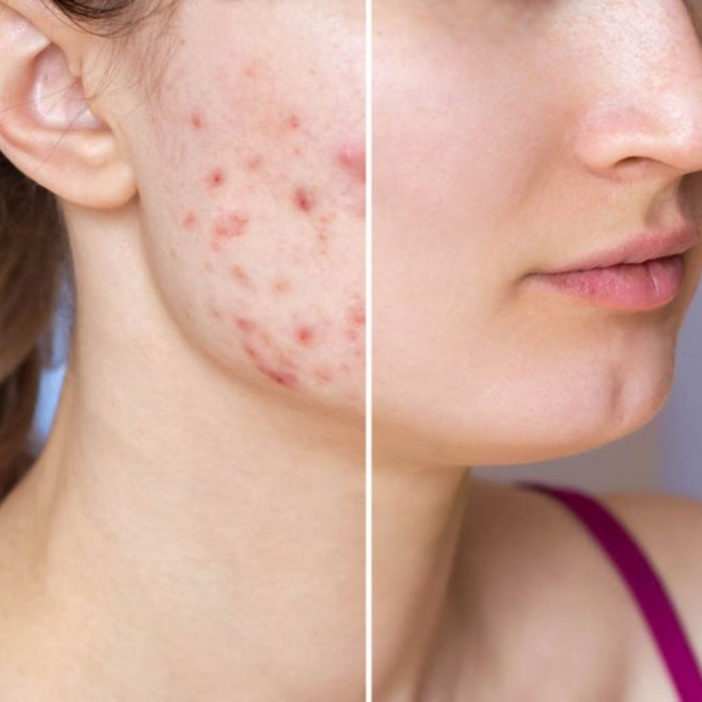 TRATAMIENTO DE ACNÉ SEVERO – MJ Esthetic Advanced
